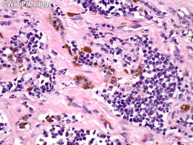 melanotic neuroectodermal tumor of infancy case report