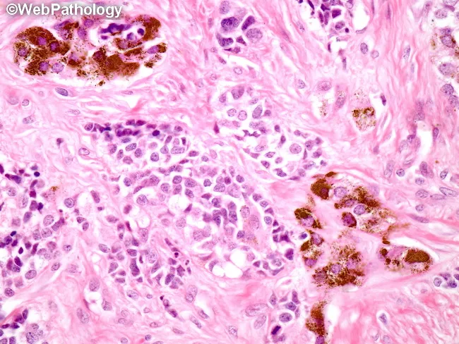 Melanotic Neuroectodermal Tumor Of Infancy