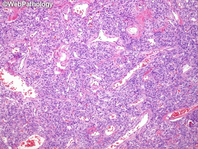 Solitary Fibrous Tumor : Histology