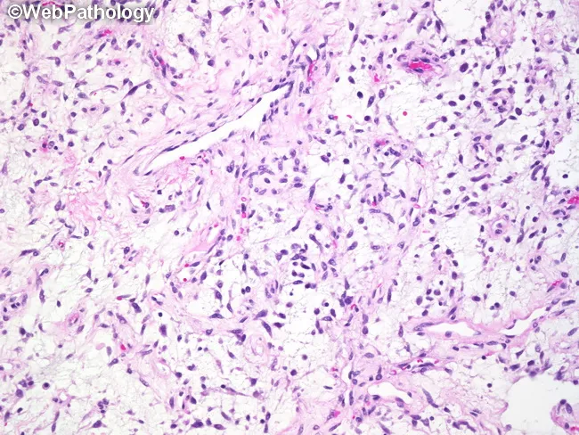 Solitary Fibrous Tumor : Myxoid Change