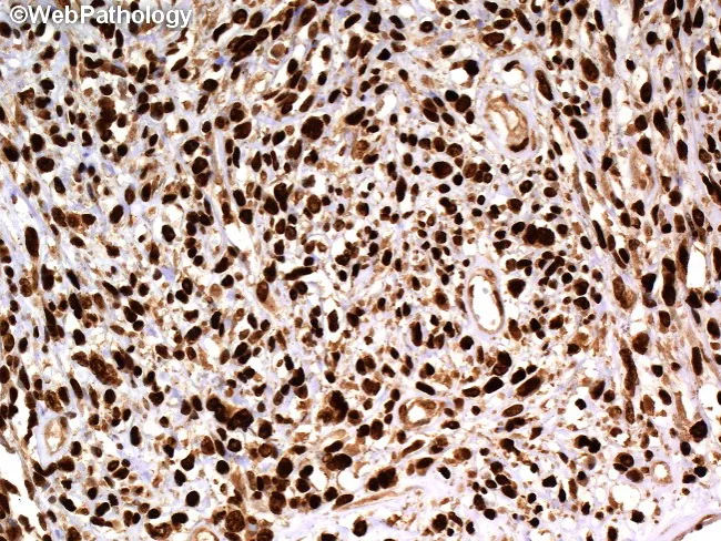 STAT6 Immunostain in Solitary Fibrous Tumor