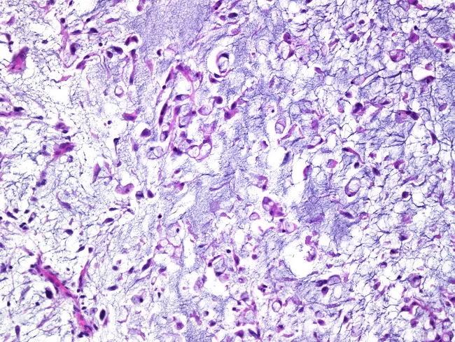 Myxoinflammatory Fibroblastic Sarcoma
