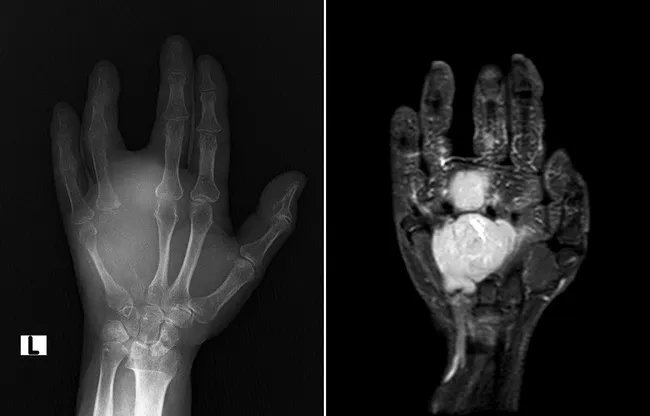 Synovial Sarcoma : Radiology