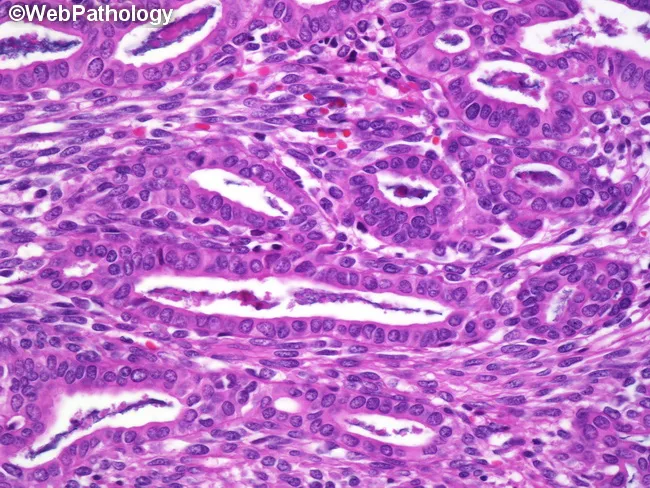 Synovial Sarcoma : Differential Diagnosis