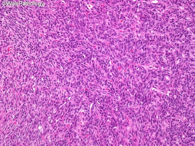 Synovial Sarcoma : Differential Diagnosis
