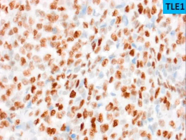 Synovial Sarcoma : TLE1 Expression
