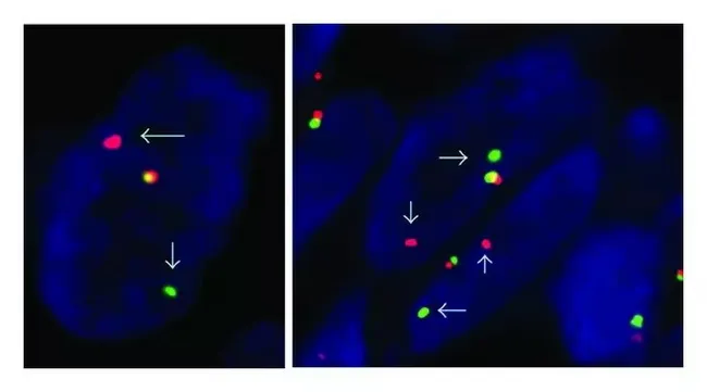 Synovial Sarcoma : Break Apart FISH
