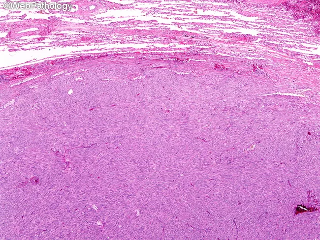 Synovial Sarcoma : Metastasis