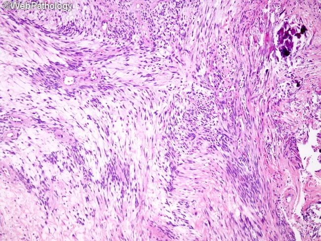 Synovial Sarcoma
