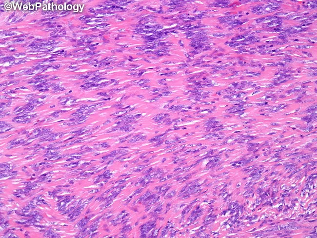 Synovial Sarcoma
