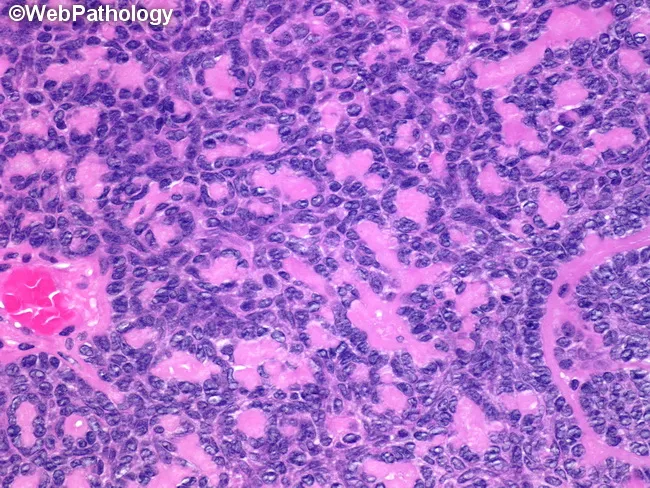 Basal Cell Adenoma : Differential Diagnosis