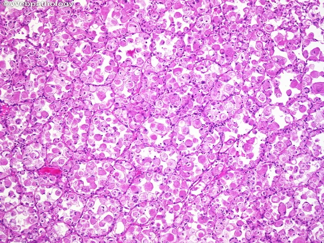 Alveolar Soft Part Sarcoma