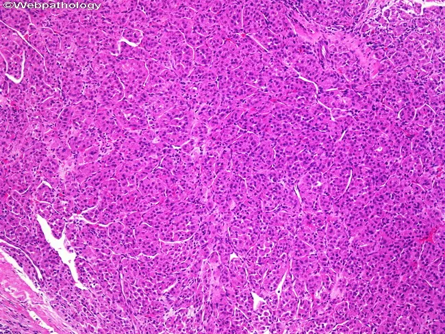 Alveolar Soft Part Sarcoma