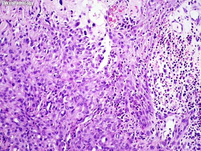 Epithelioid Sarcoma