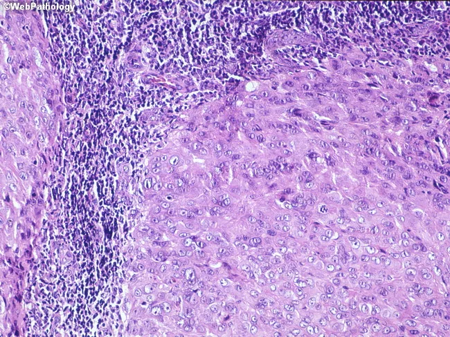 Epithelioid Sarcoma Metastatic to Lymph Node
