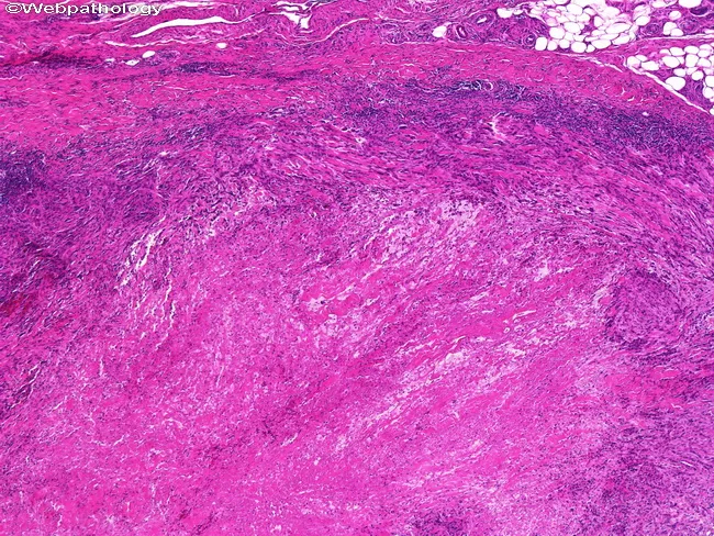 Epithelioid Sarcoma
