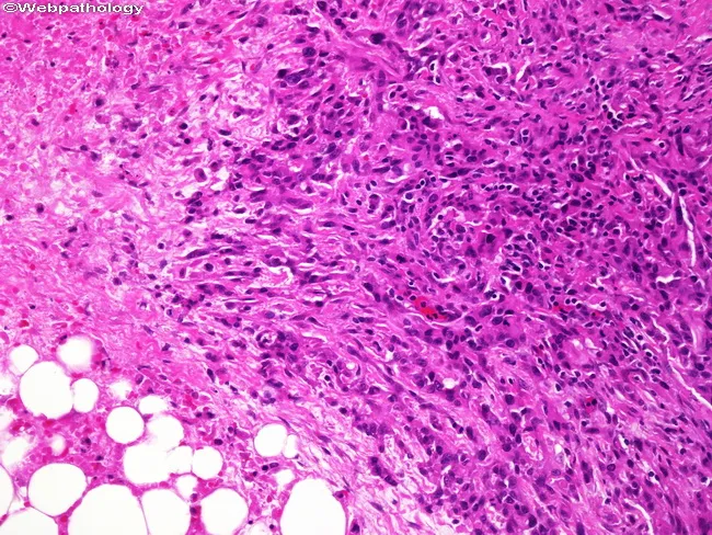 Epithelioid Sarcoma