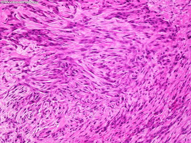 Epithelioid Sarcoma
