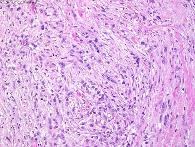 Epithelioid Sarcoma