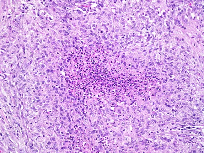 Epithelioid Sarcoma