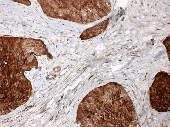 Desmoplastic Small Round Cell Tumor : NSE