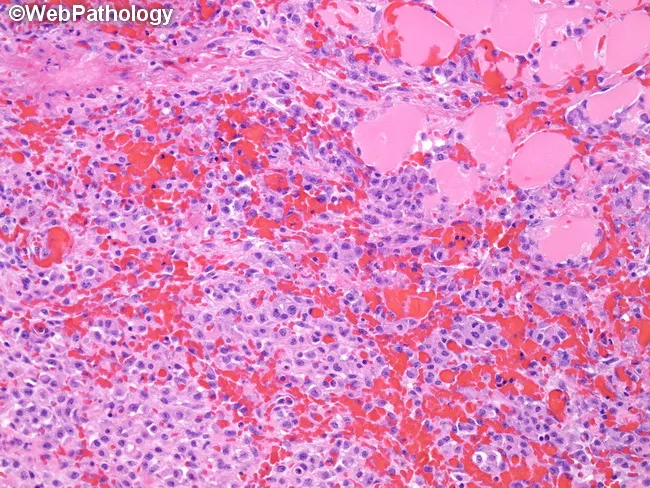 Malignant Extra-Renal Rhabdoid Tumor : Introduction