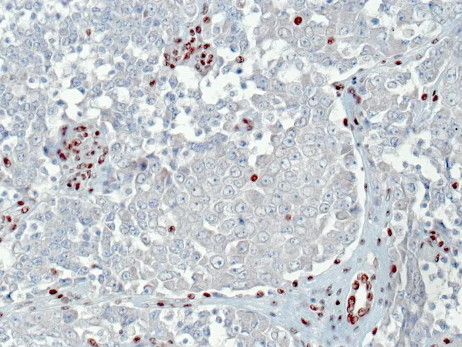 Malignant Extra-Renal Rhabdoid Tumor : Loss of INI1 Expression