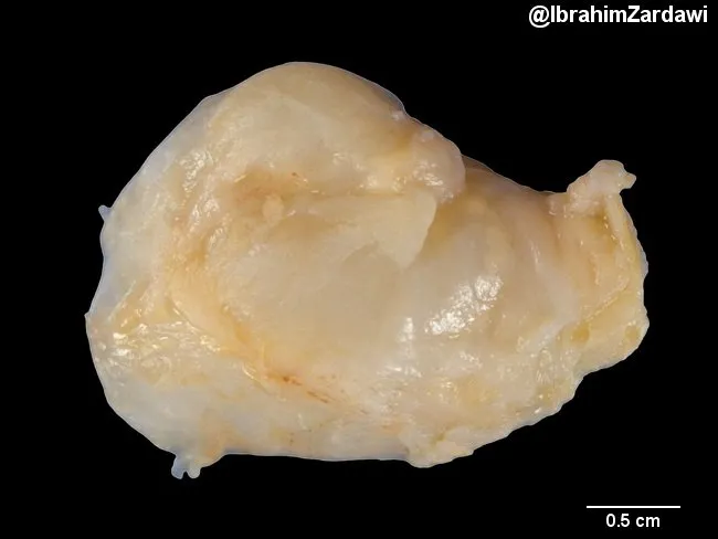 Ganglion : Clinical Features