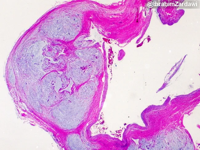 Ganglion : Microscopic Features