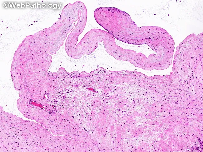 Ganglion : Differential Diagnosis
