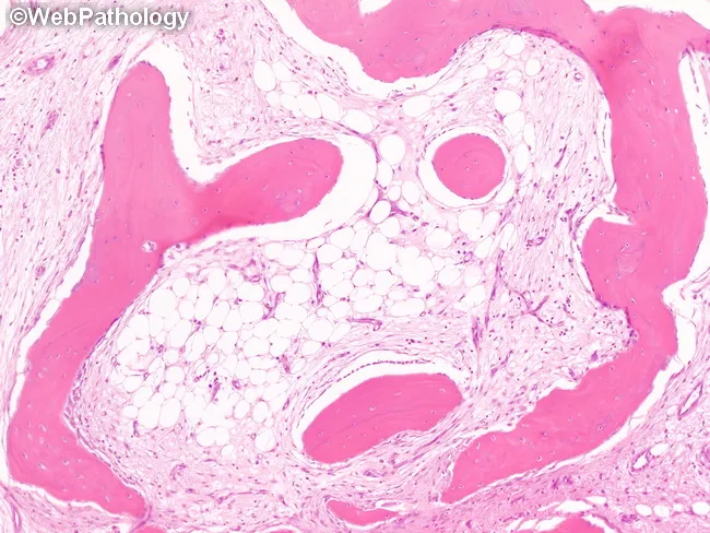 Myositis Ossificans