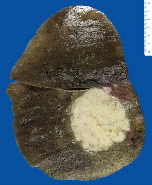 Adenocarcinoma of Lung : Definition