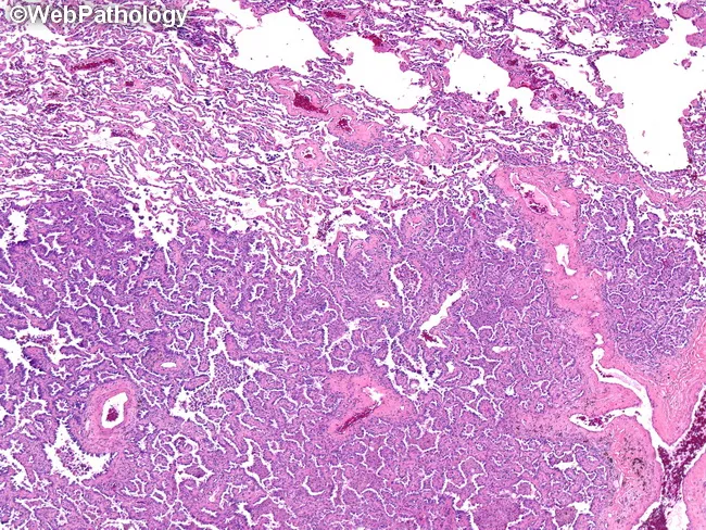 lung cancer histology quiz