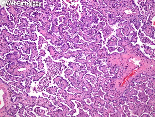 Lepidic Adenocarcinoma : Definition