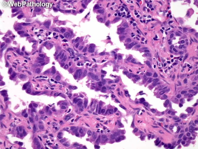 Lepidic Adenocarcinoma