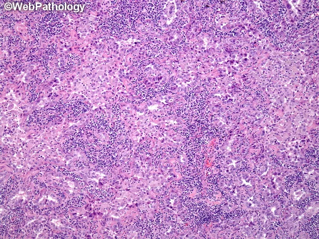 Lepidic Adenocarcinoma : Invasive Component