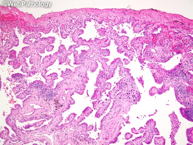 Lepidic AdenoCA VS Minimally-invasive AdenoCA