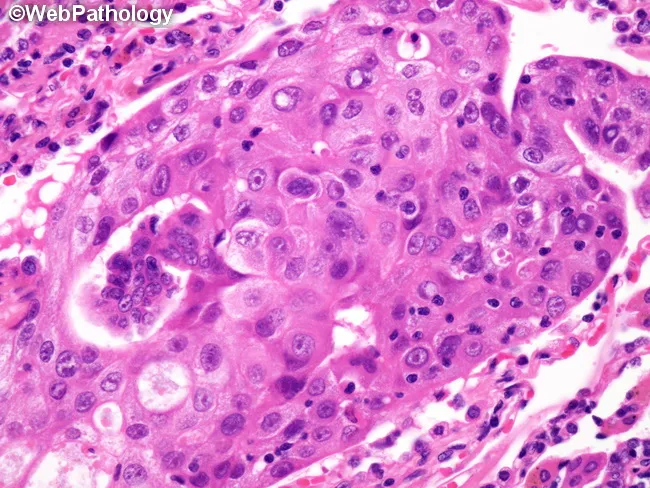 Solid Adenocarcinoma