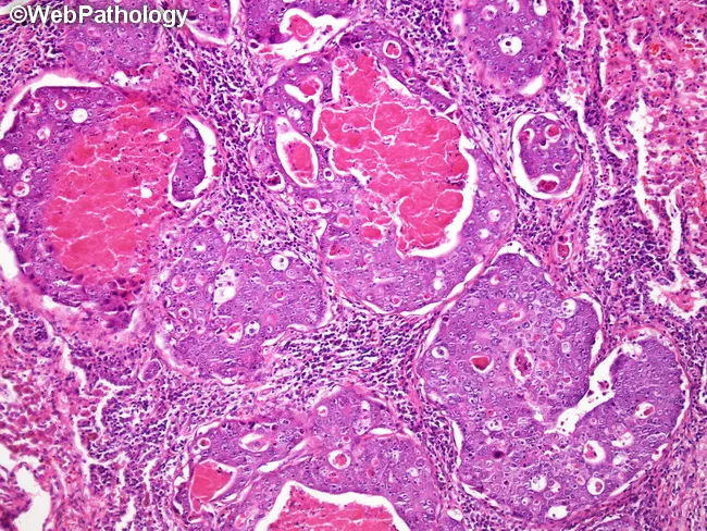 Solid Adenocarcinoma
