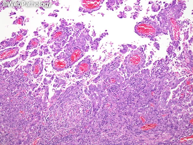 Solid Adenocarcinoma