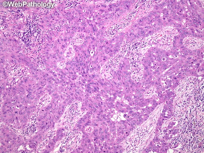Solid Adenocarcinoma