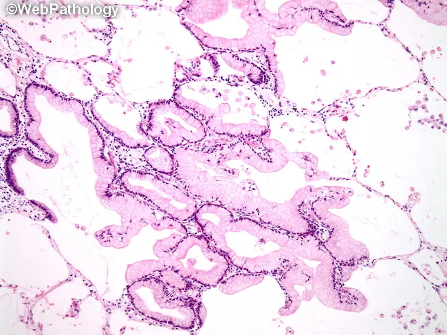 Invasive Mucinous Adenocarcinoma