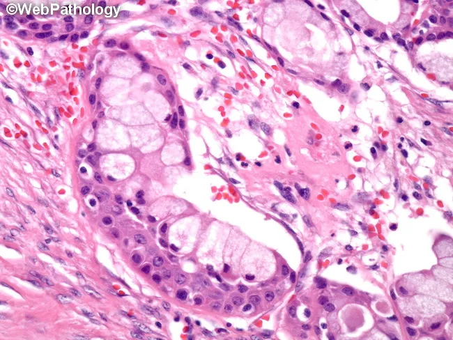 Mucoepidermoid Carcinoma : Low-grade