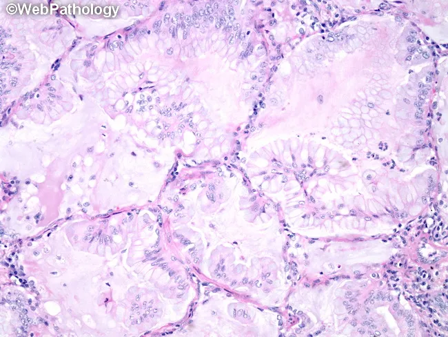 Invasive Mucinous Adenocarcinoma
