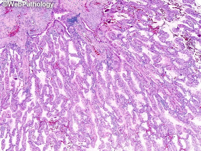 Invasive Mucinous Adenocarcinoma
