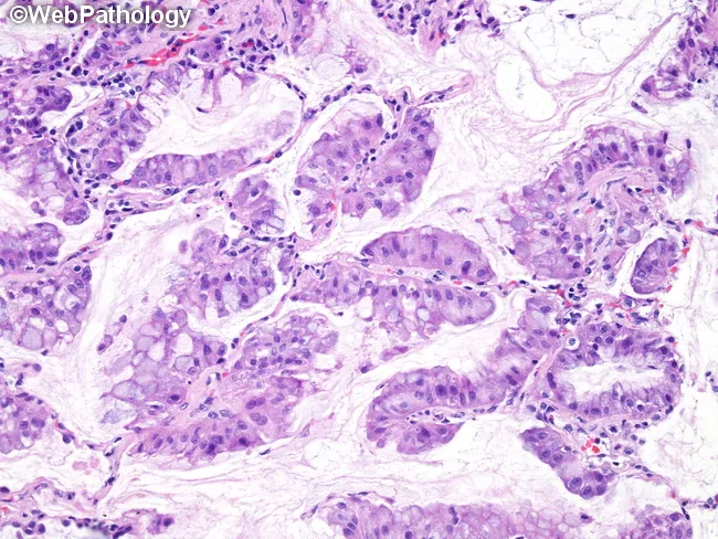Invasive Mucinous Adenocarcinoma