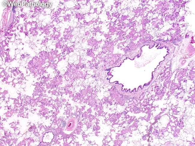 Invasive Mucinous Adenocarcinoma