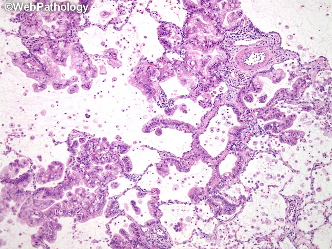 Invasive Mucinous Adenocarcinoma