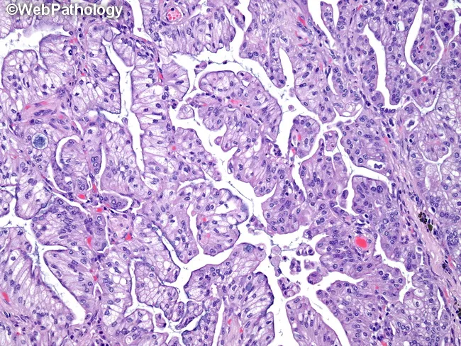 Invasive Mucinous Adenocarcinoma