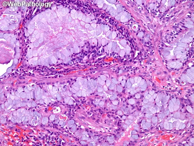 Mucoepidermoid Carcinoma : Low-grade